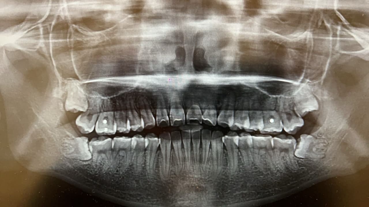 水平智齒，四顆一次全拔 - B28 留言 | Dcard