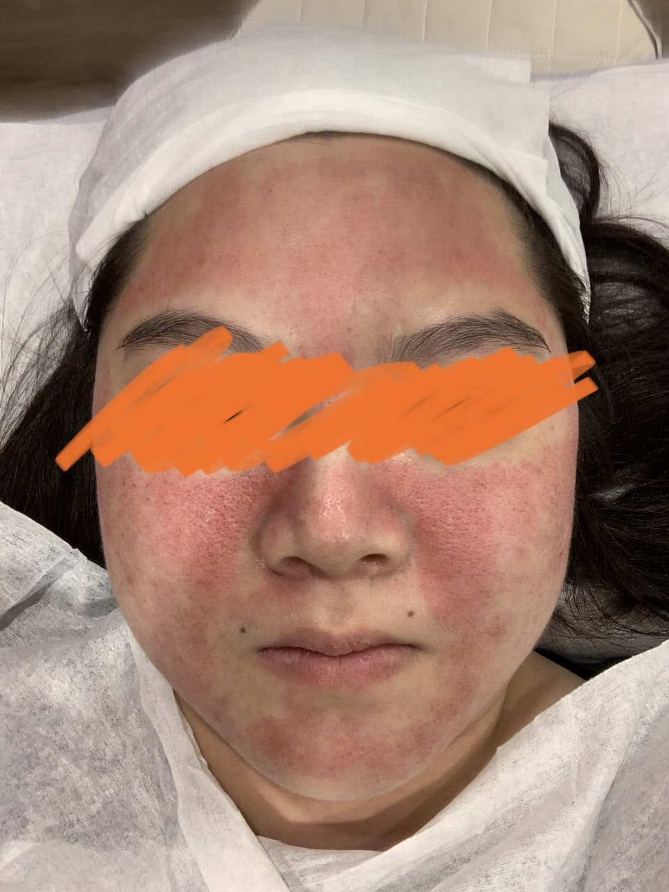 #分享 人生皮秒初體驗 - 醫美板 | Dcard