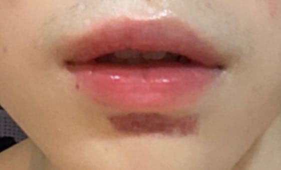 #分享 #圖 男生縮唇分享 - 醫美板 | Dcard