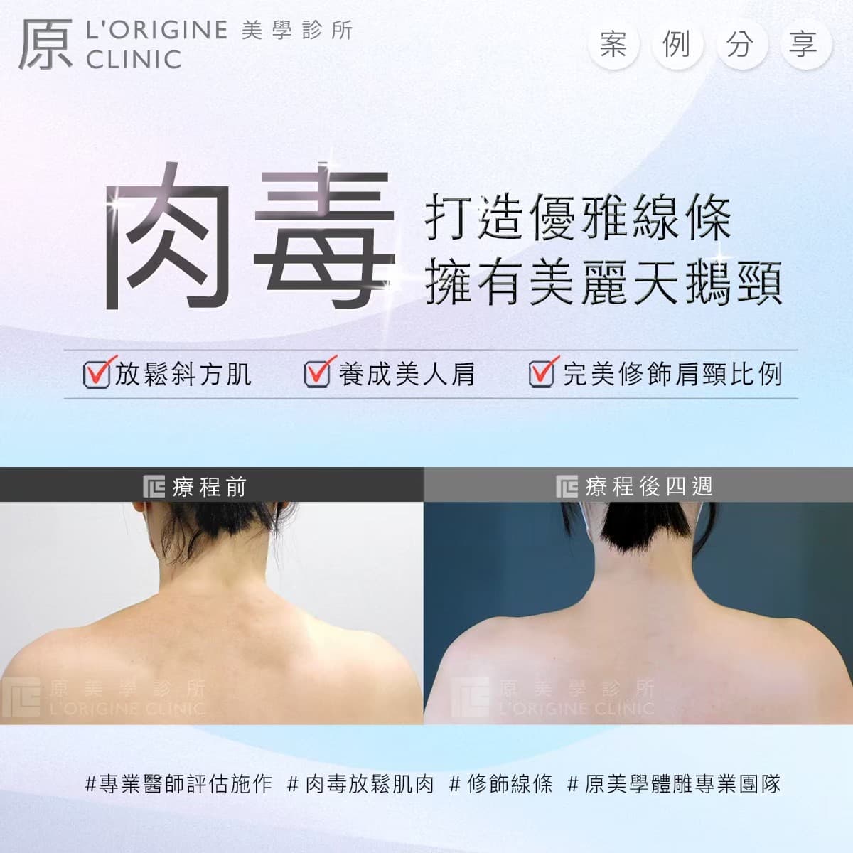 #分享 肉毒桿菌素打造纖長線條 - 原美學診所 (@lorigine) | Dcard