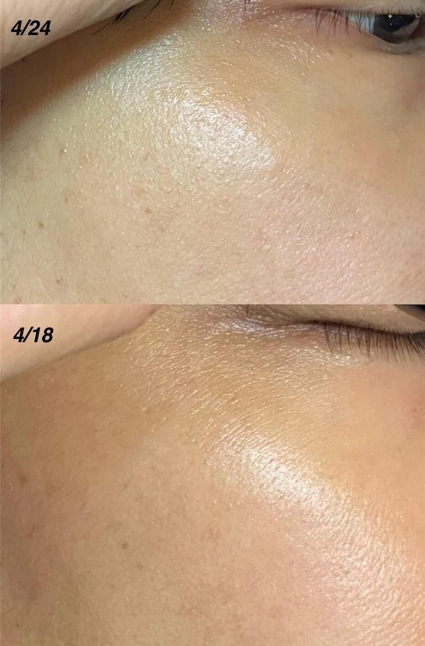 一顆老青春痘，讓我挖掘出 CBD + NMN 延緩老化的功效，膠原蛋白免了拉！ - 閒聊板 | Dcard