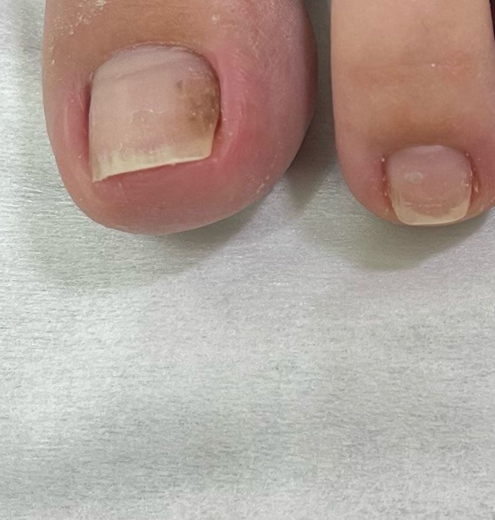 問題 請問這算灰指甲嗎? 美甲板 Dcard