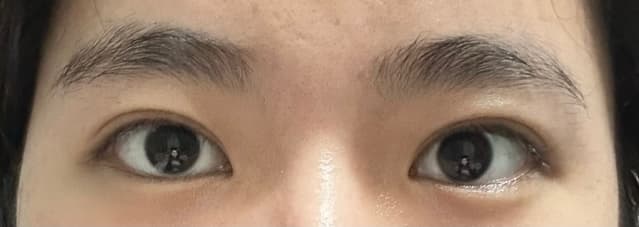 #詢問 提眉、雙眼皮手術 - B18-4 留言 | Dcard