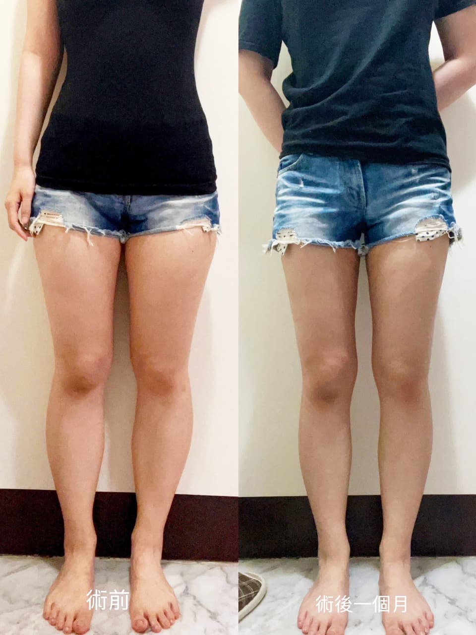 #分享 超有感的大小腿抽脂&PRP補胸 part 1 - 醫美板 | Dcard