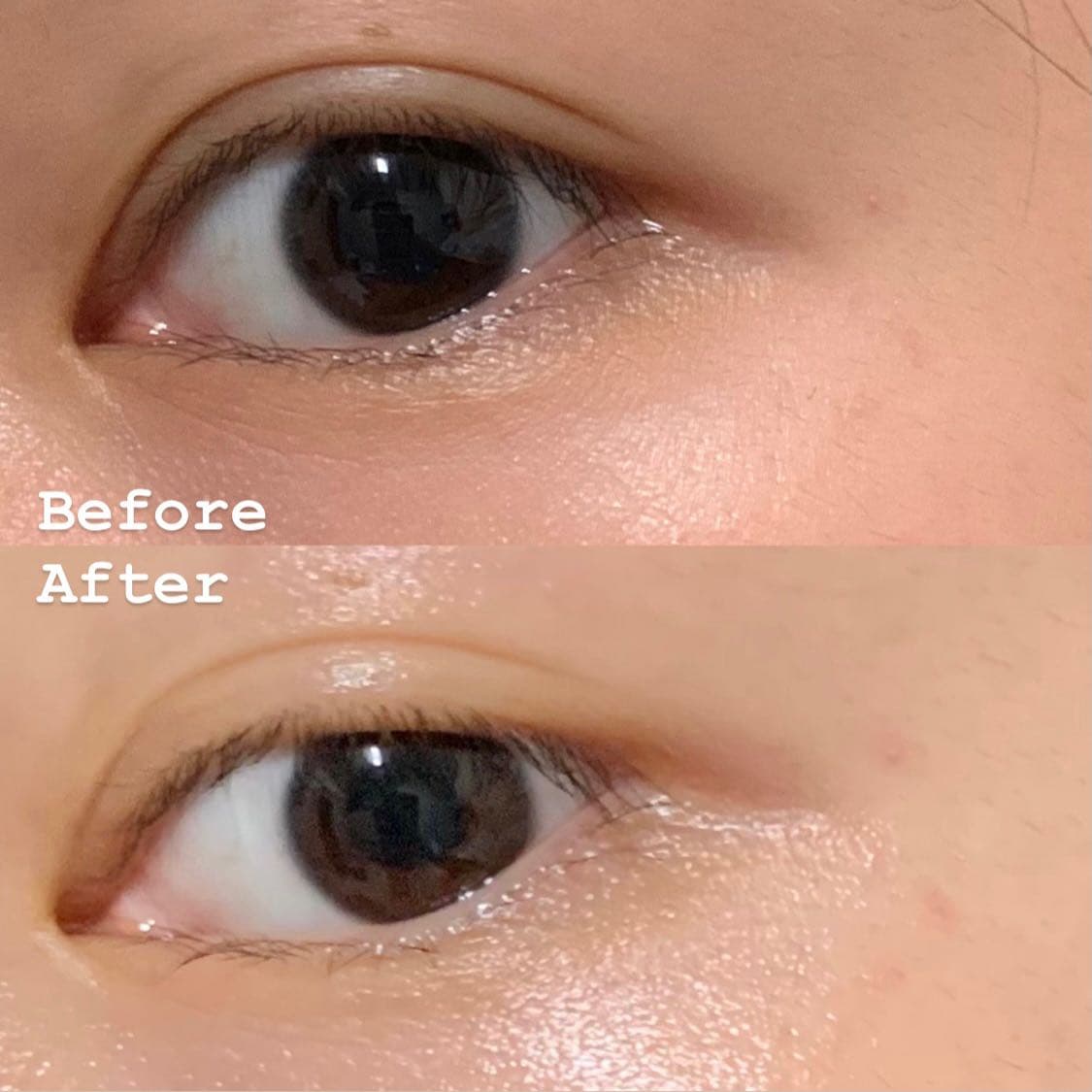 細紋out、肉芽bye - 贊助板 | Dcard