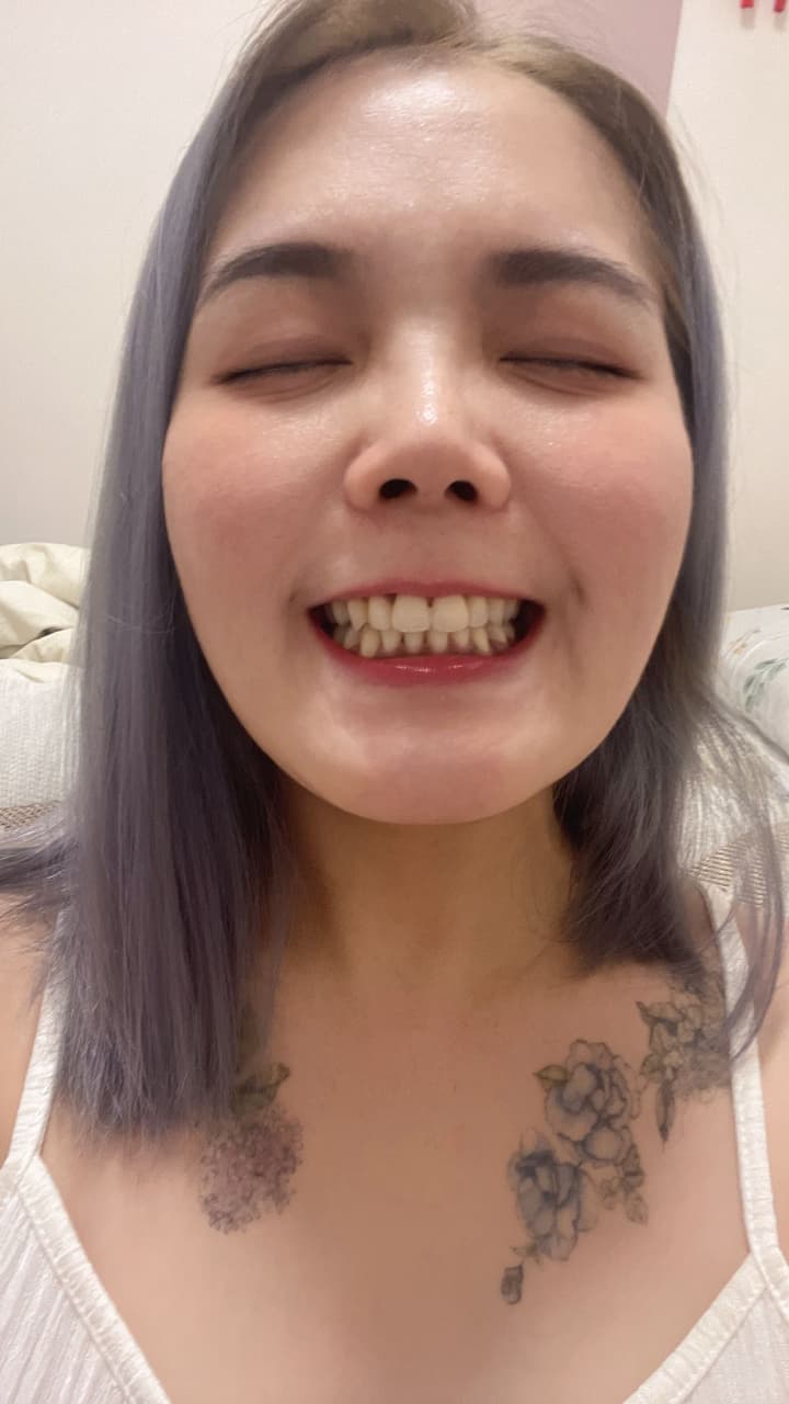 #分享 傳統矯正器VS隱形牙套分享心得（文長慎入） - 醫美板 | Dcard