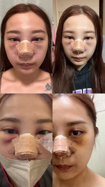 #分享 20y去三段式隆鼻？？？ - 醫美板 | Dcard