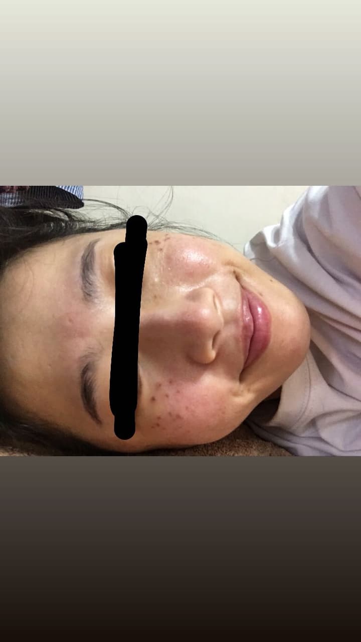 #詢問 長＊醫院的醫美診所打皮秒 - B2 留言 | Dcard