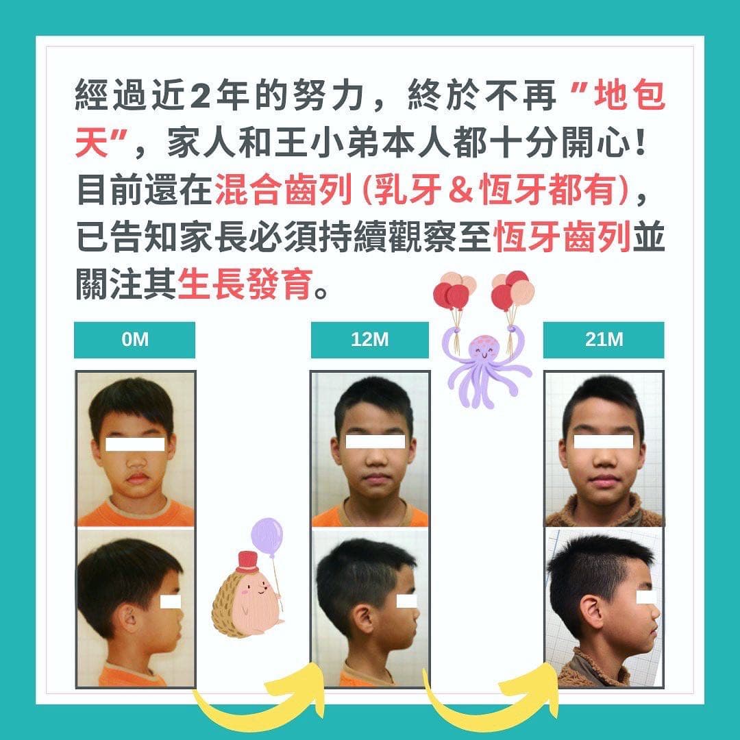 「戽斗遺傳」也能透過「肌肉訓練」來改善？【案例故事分享】 - 舊「魔法兔健康冷知識」 (@magictooth) | Dcard