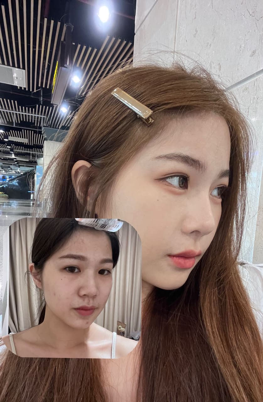 醫美小白入坑的小建議 - Han｜美妝｜優惠情報 (@charlene717_) | Dcard