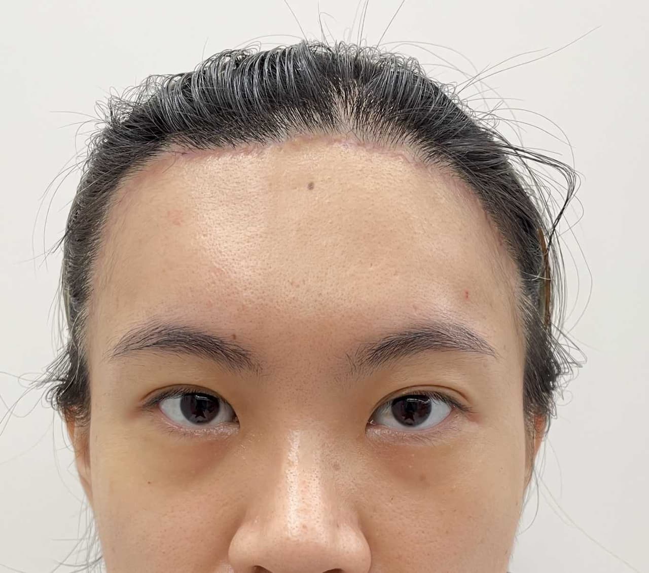 #分享 想要雙眼皮卻變成去拉皮XD - B26 留言 | Dcard