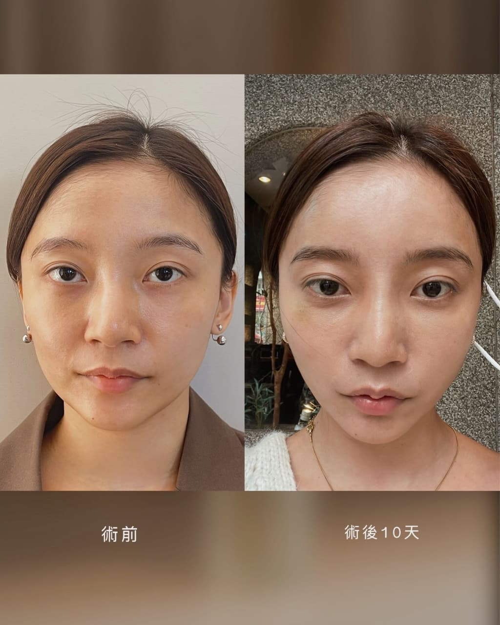 #分享 第一次的埋線體驗🥹原本超抗拒沒想到竟然…（術後8個月） - 醫美板 | Dcard