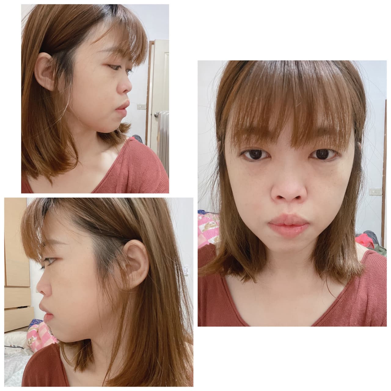 #分享 想了20幾年終於隆鼻跟縫雙眼皮了 - B44 留言 | Dcard