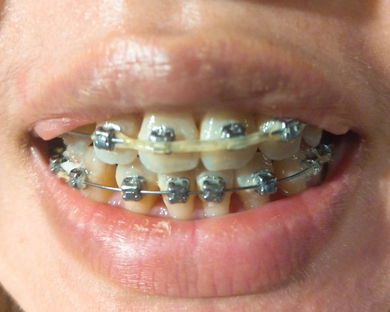 矯正牙齒全記錄！ - B82 留言 | Dcard