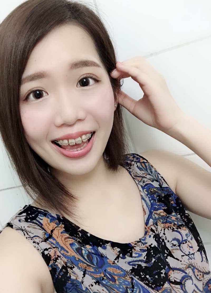 #更#圖 割雙眼皮術後一個月分享 - B192 留言 | Dcard