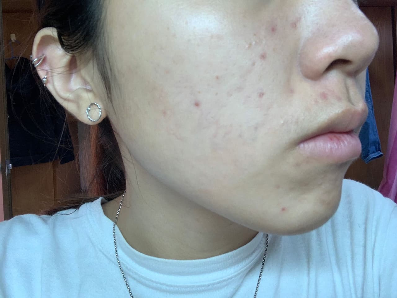 問!痘疤消除 美妝板 Dcard