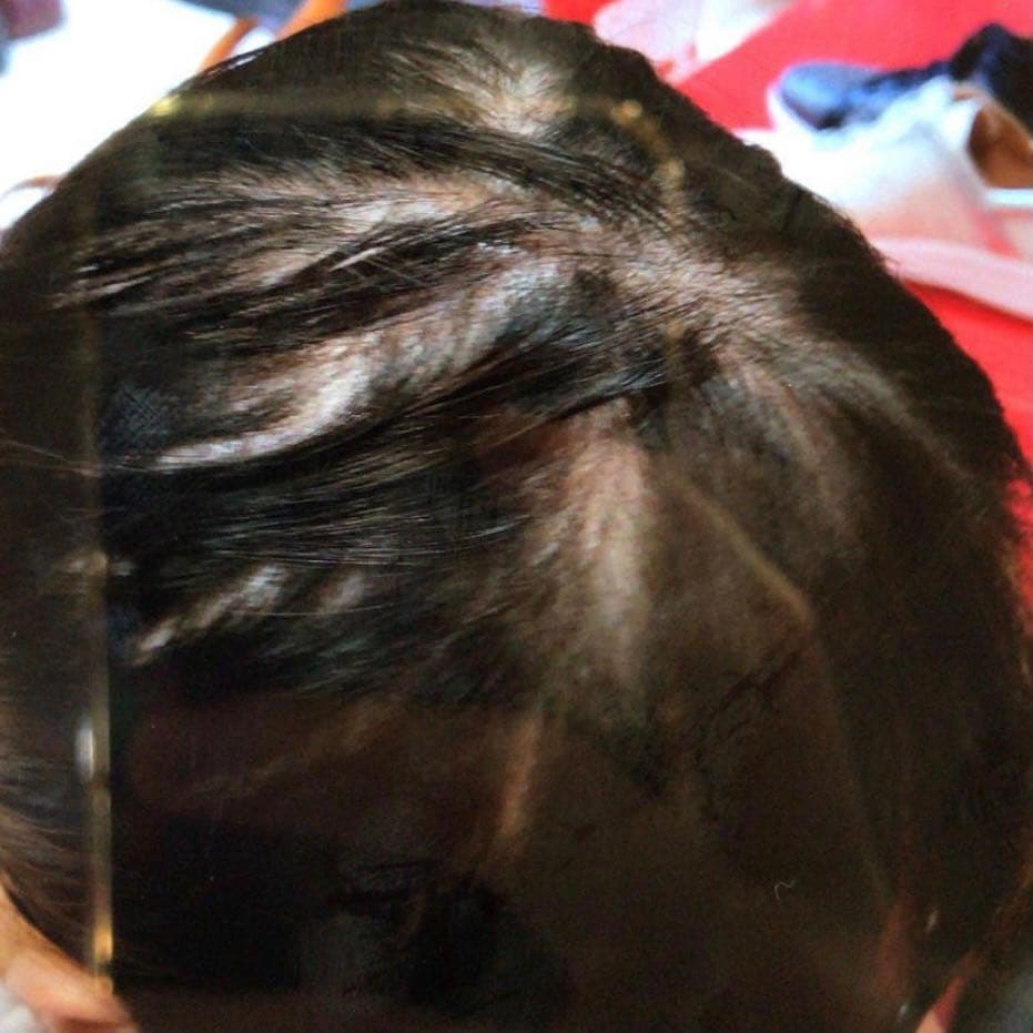 有女孩也禿頭嗎⋯ - B92 留言 | Dcard