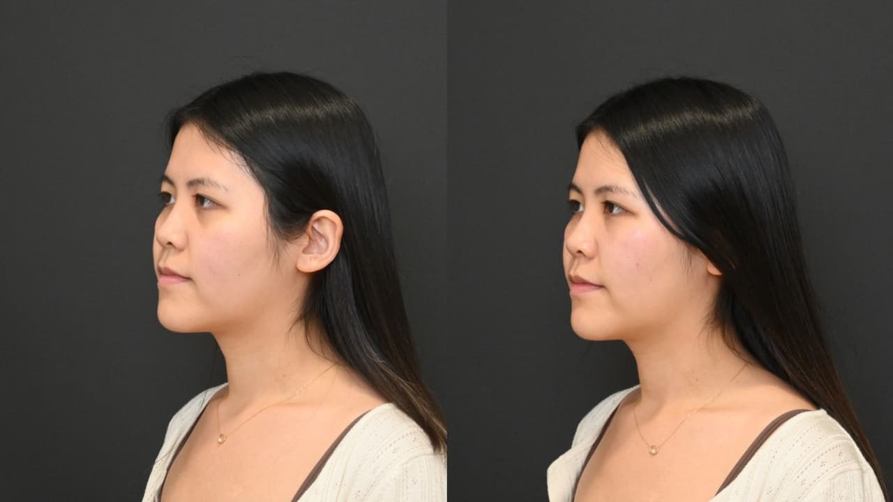 #分享 24歲第一次醫美 保柔緹玻尿酸2cc心得 - 醫美板 | Dcard