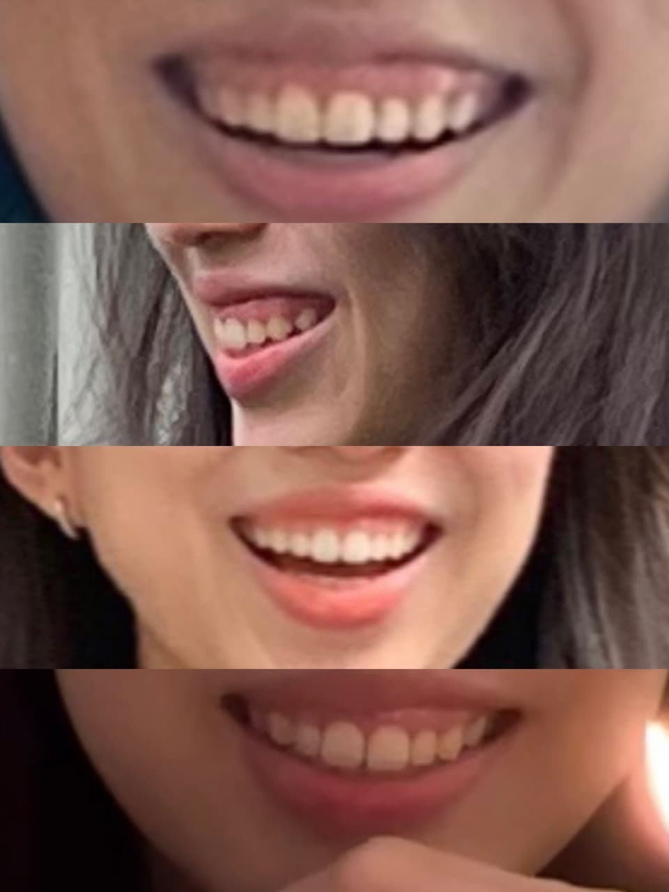 笑齦問題 - 牙齒矯正板 | Dcard