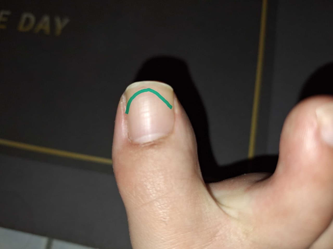 問題 求救!請問這到底是不是甲床分離 美甲板 Dcard