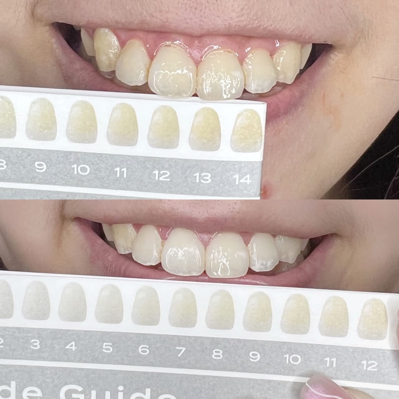 #分享 #好物生活提案 牙齒真的變白了🦷還可以DIY齒模！｜Lab52齒研堂 - 美妝板 | Dcard