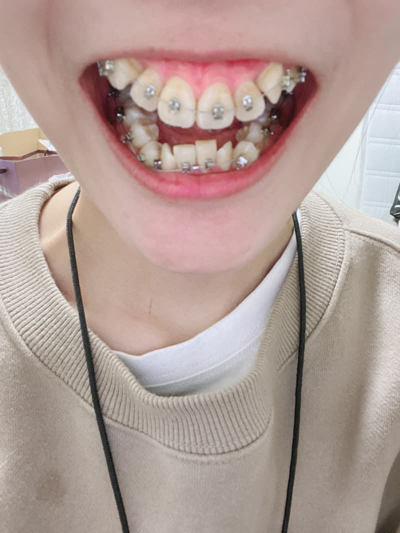 矯正牙齒全記錄！ - B256 留言 | Dcard