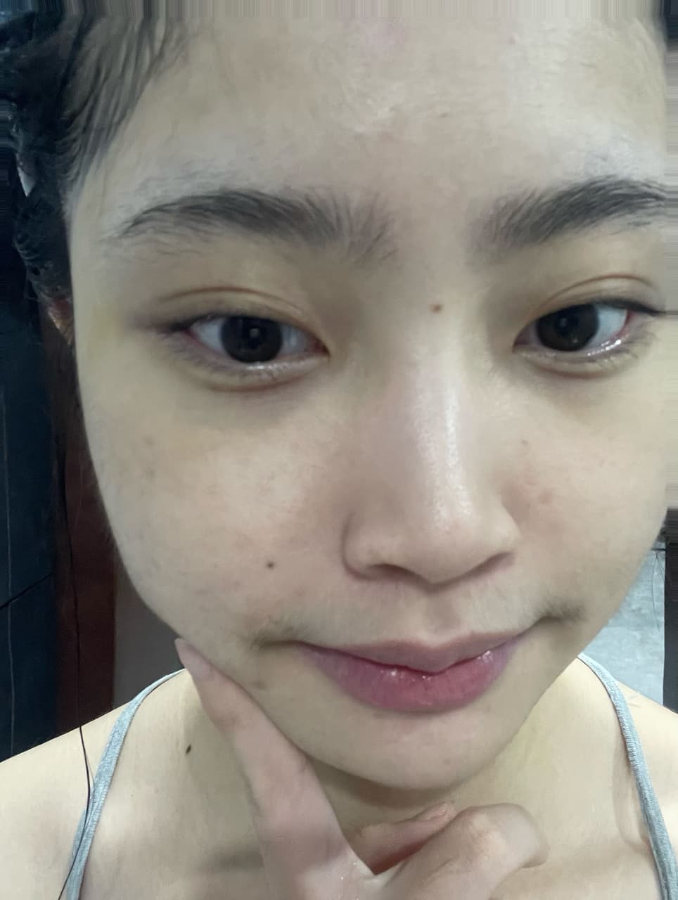 #分享 韓國🇰🇷大保養 水光針麗珠蘭&美音&削骨恢復實紀 - 醫美板 | Dcard