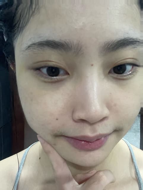 #分享 韓國🇰🇷大保養 水光針麗珠蘭&美音&削骨恢復實紀 - 醫美板 | Dcard