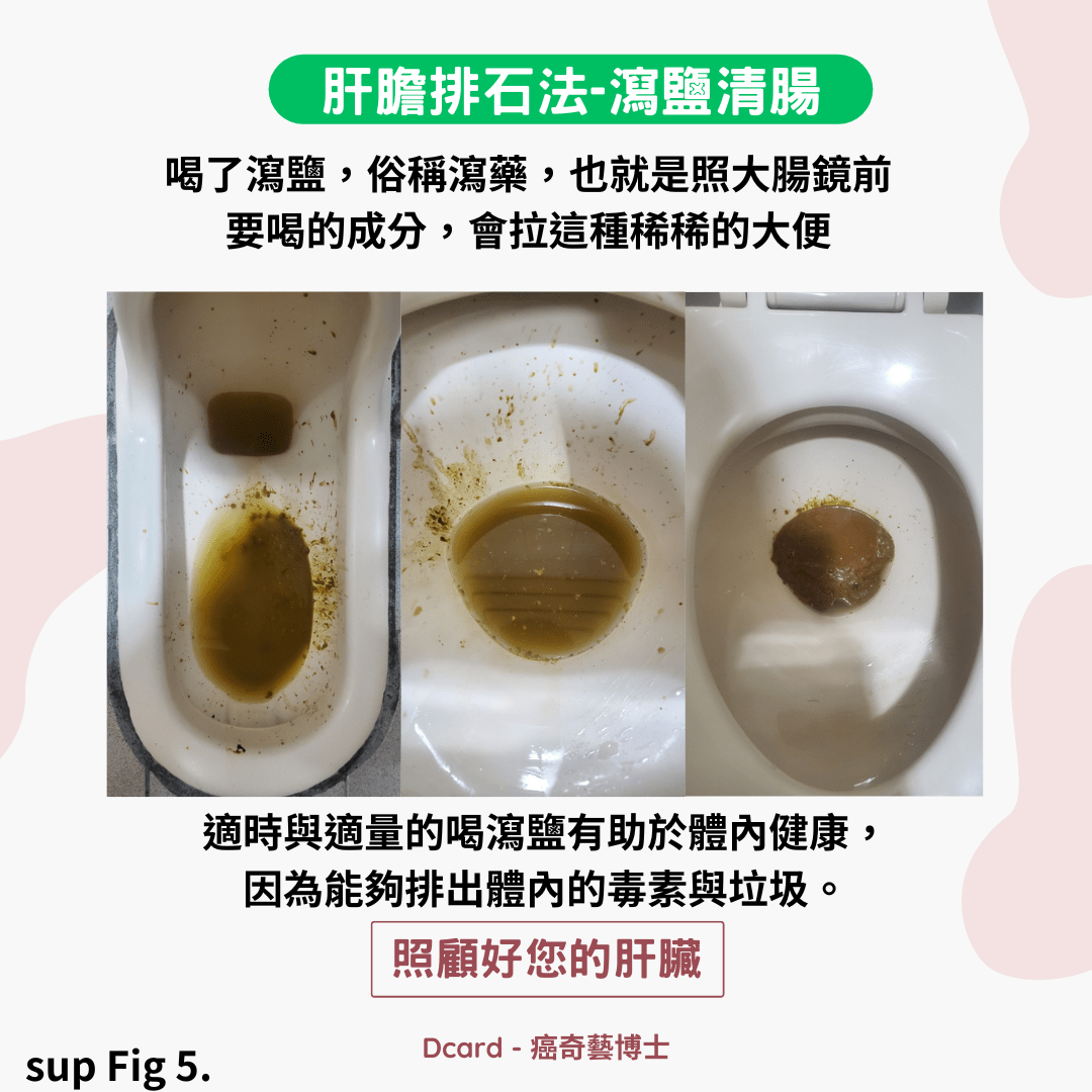 肝膽排石法的3次實際體驗過程與心得(文長，有屎照) - 癌奇藝博士 (@gd810424) | Dcard