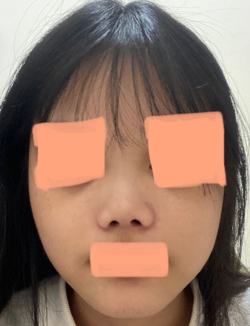 #詢問 #詢問 隆鼻醫師推薦 - B2-1 留言 | Dcard