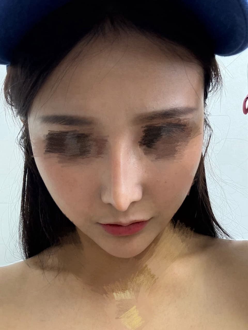 #討論 最近很紅的柯X達隆鼻~一週就歪，六個月後還在等『負責』！ - 醫美板 | Dcard