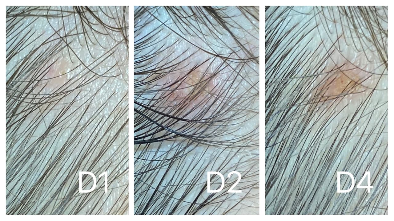 NARUKO茶樹抗痘粉刺寶實測#開箱大使 - 木木 (@dmlu) | Dcard