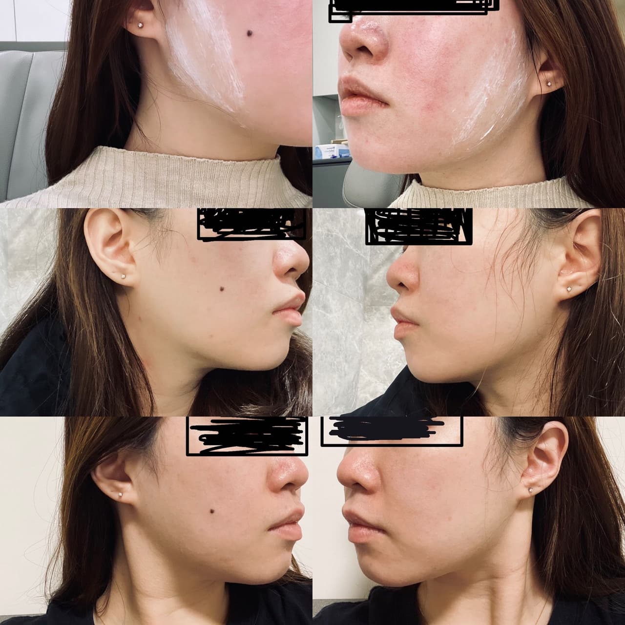 #分享 #分享 釜山醫美V-ro，咀嚼肌肉毒 - 韓國旅遊板 | Dcard