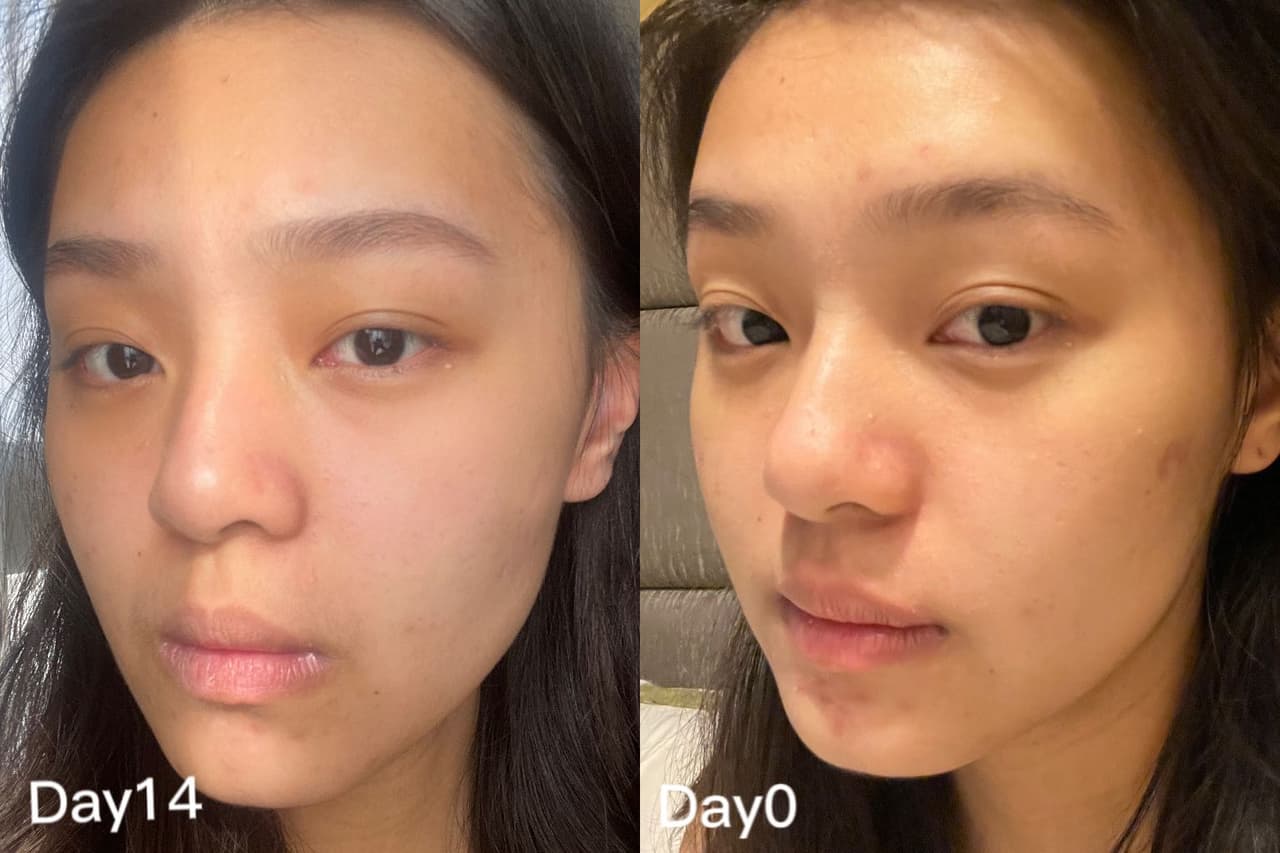 熬夜粉刺女孩只需要這瓶就夠!! feat. 翠芙思TriForce - 快樂的瓜農 (@emmaho) | Dcard