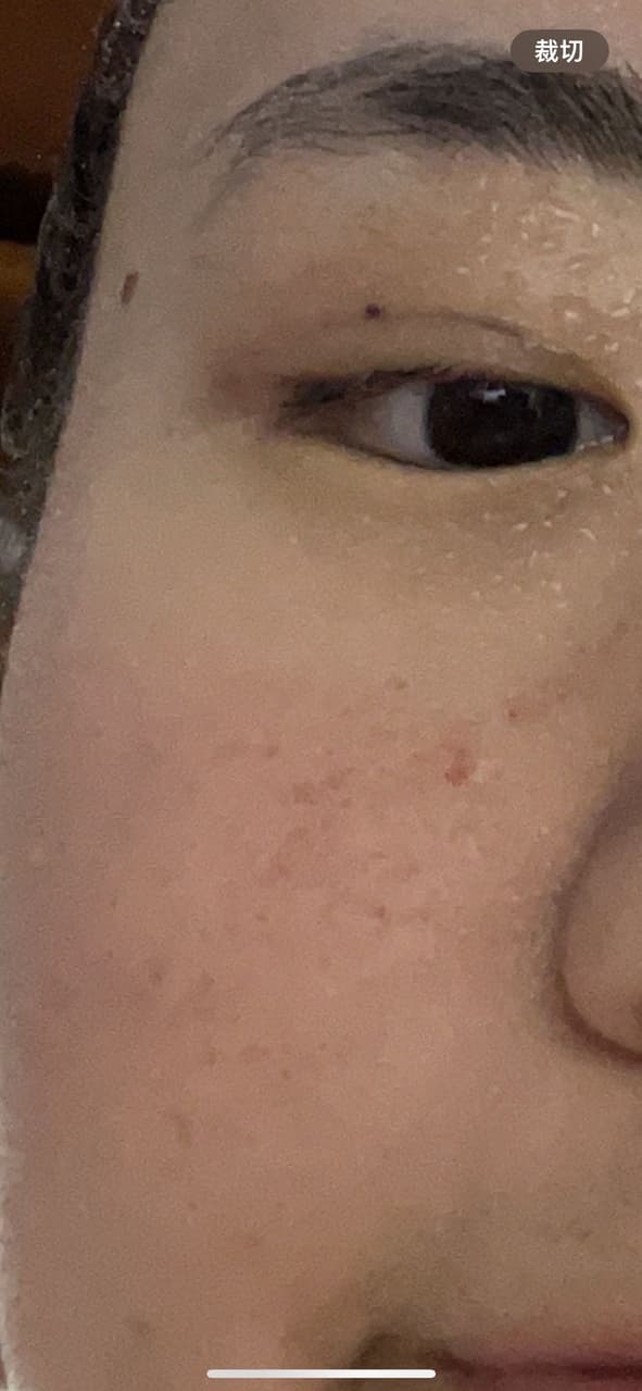 #詢問 打完蜂巢皮秒後好幾天還沒恢復是正常的嗎 - 醫美板 | Dcard