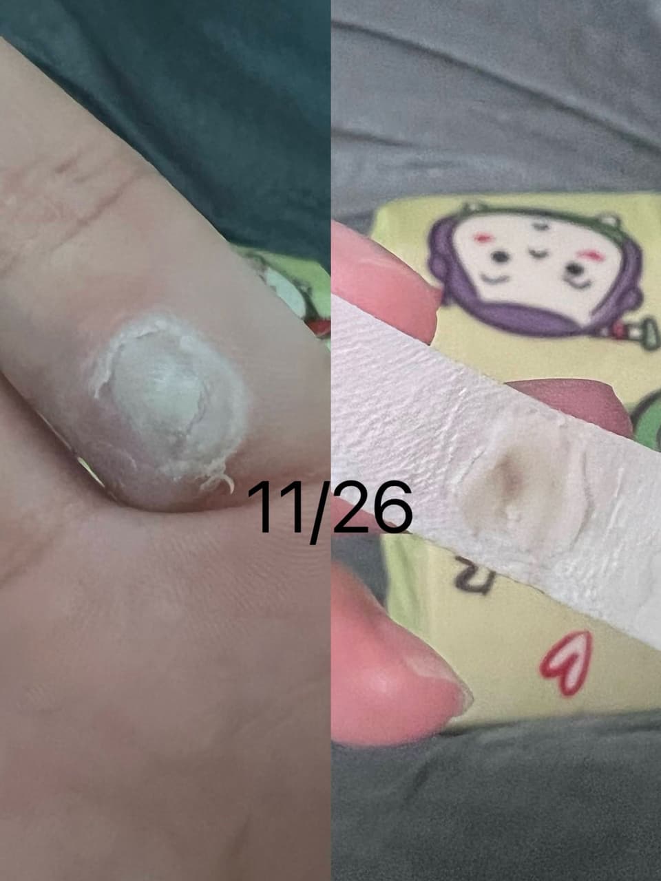 病毒疣治療看這邊（上篇勿刪重發） - B89 留言 | Dcard