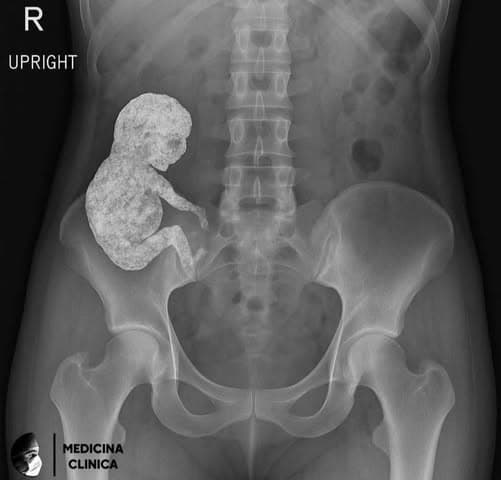 胎死腹中30年！偏鄉孕婦難就醫 74歲肚痛產下「石胎」 - SETN三立新聞網 (@setn54) | Dcard