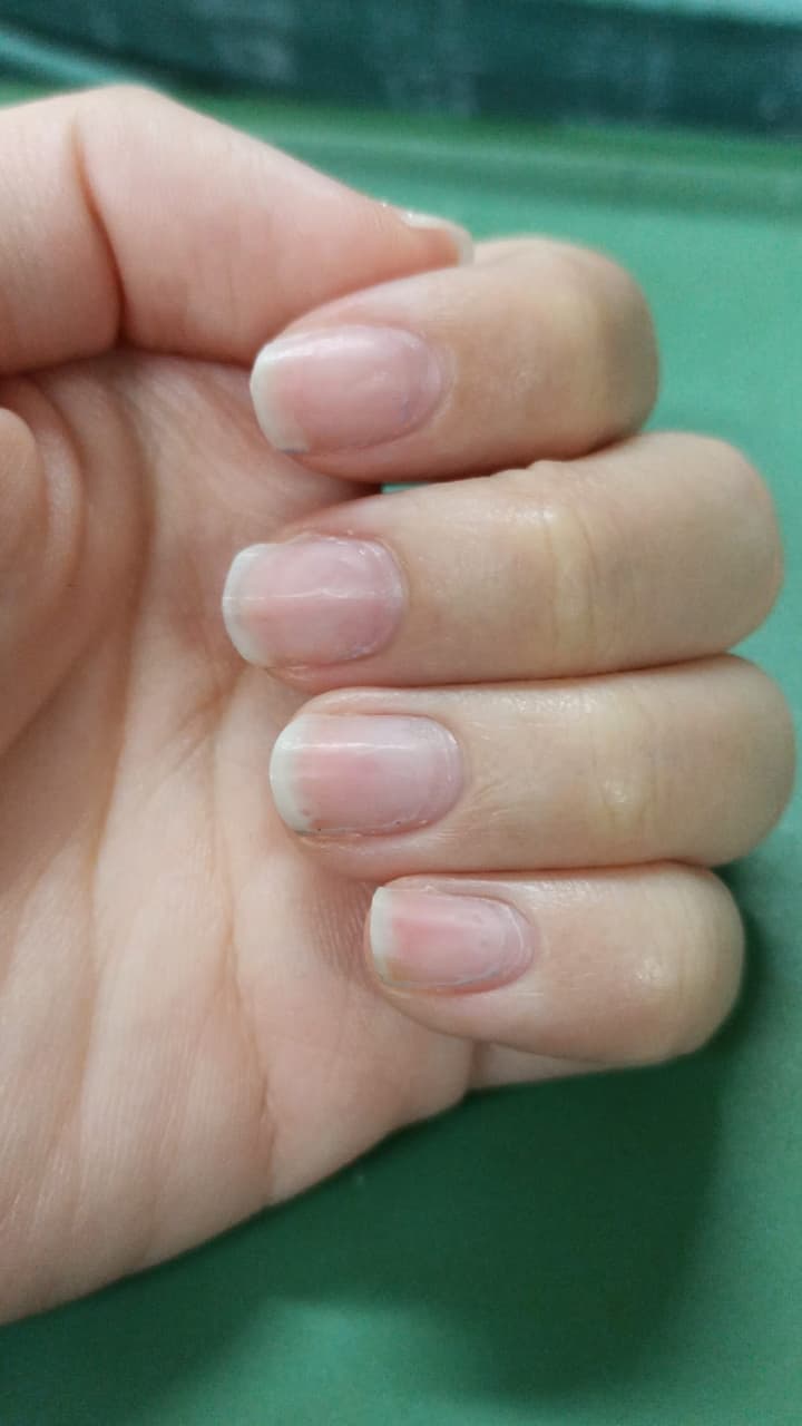 黑特 卸甲沒卸乾淨又受傷 美甲板 Dcard