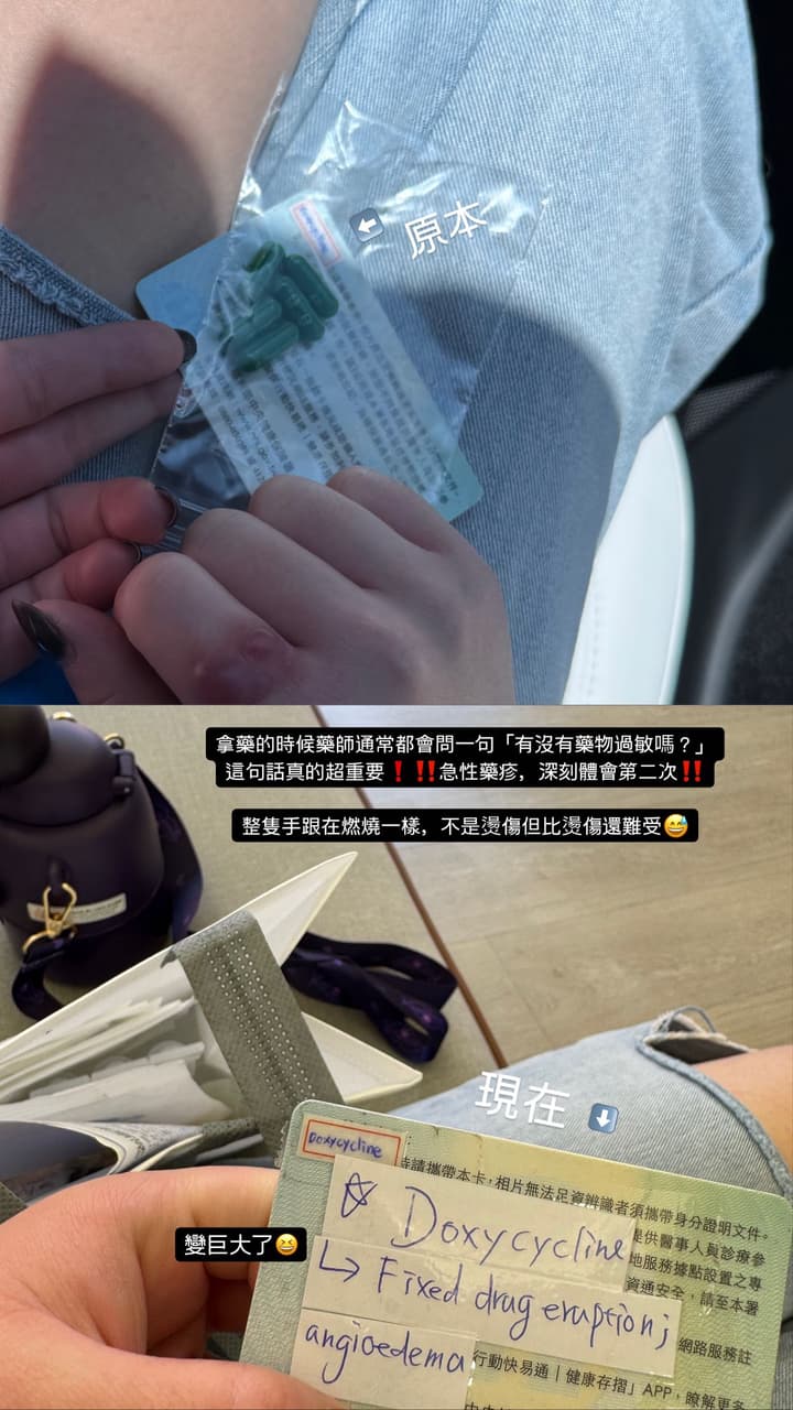 #討論 真實分享｜#黑特 #文長 竹北維 醫美療程引發藥物過敏，爛臉、灼傷、水泡＋申請病歷還要「公司審核」🤯 - 醫美板 | Dcard