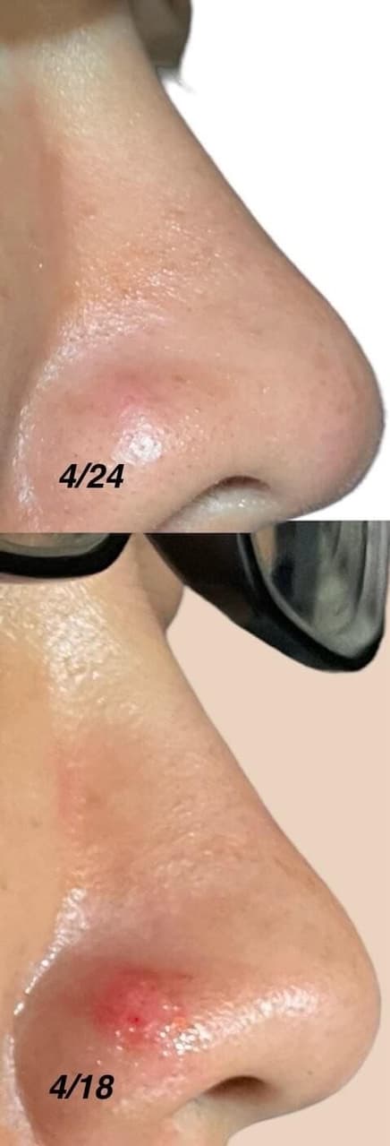 一顆老青春痘，讓我挖掘出 CBD + NMN 延緩老化的功效，膠原蛋白免了拉！ - 閒聊板 | Dcard