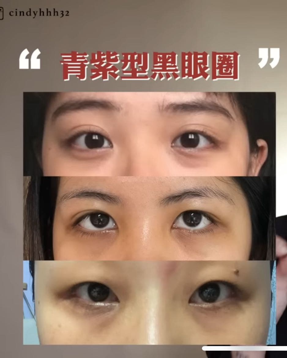 #分享 24歲第一次醫美 保柔緹玻尿酸2cc心得 - 醫美板 | Dcard