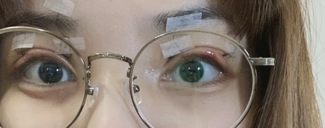 圖多#提眼瞼肌手術修飾大小眼 - B151 留言 | Dcard
