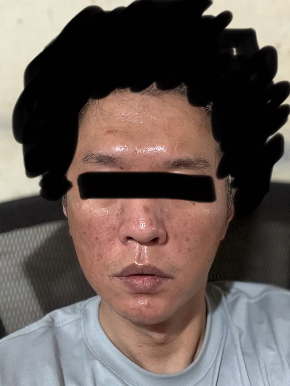 #分享 【懺悔】TM的UP雷射修復期 - 醫美板 | Dcard