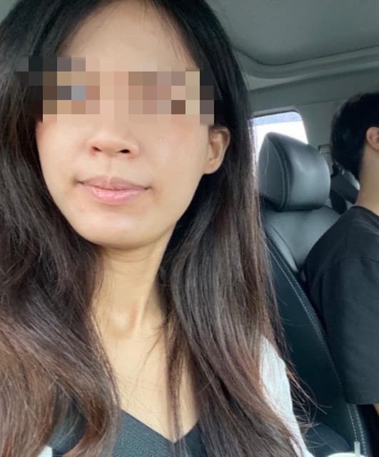 #分享 台北超有感皮秒蜂巢雷射！爆痘人的急救好夥伴🥺 - 醫美板 | Dcard