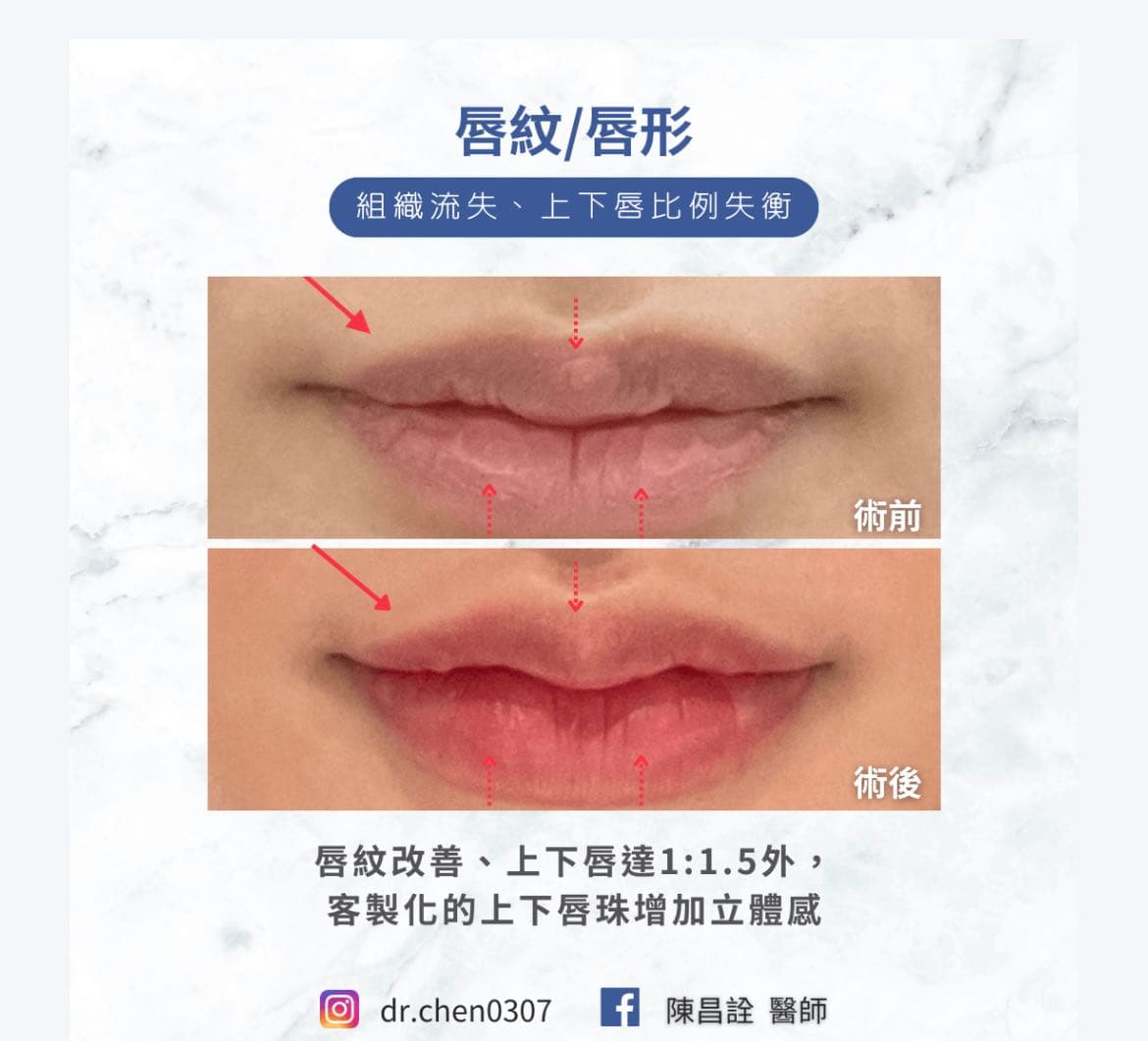 嘴唇玻尿酸填充分享 - 陳昌詮 醫師 (@dr_chen0307) | Dcard