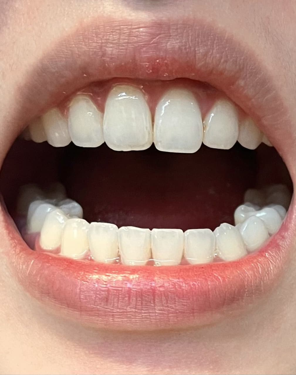 矯正牙齒全記錄！ - B166 留言 | Dcard