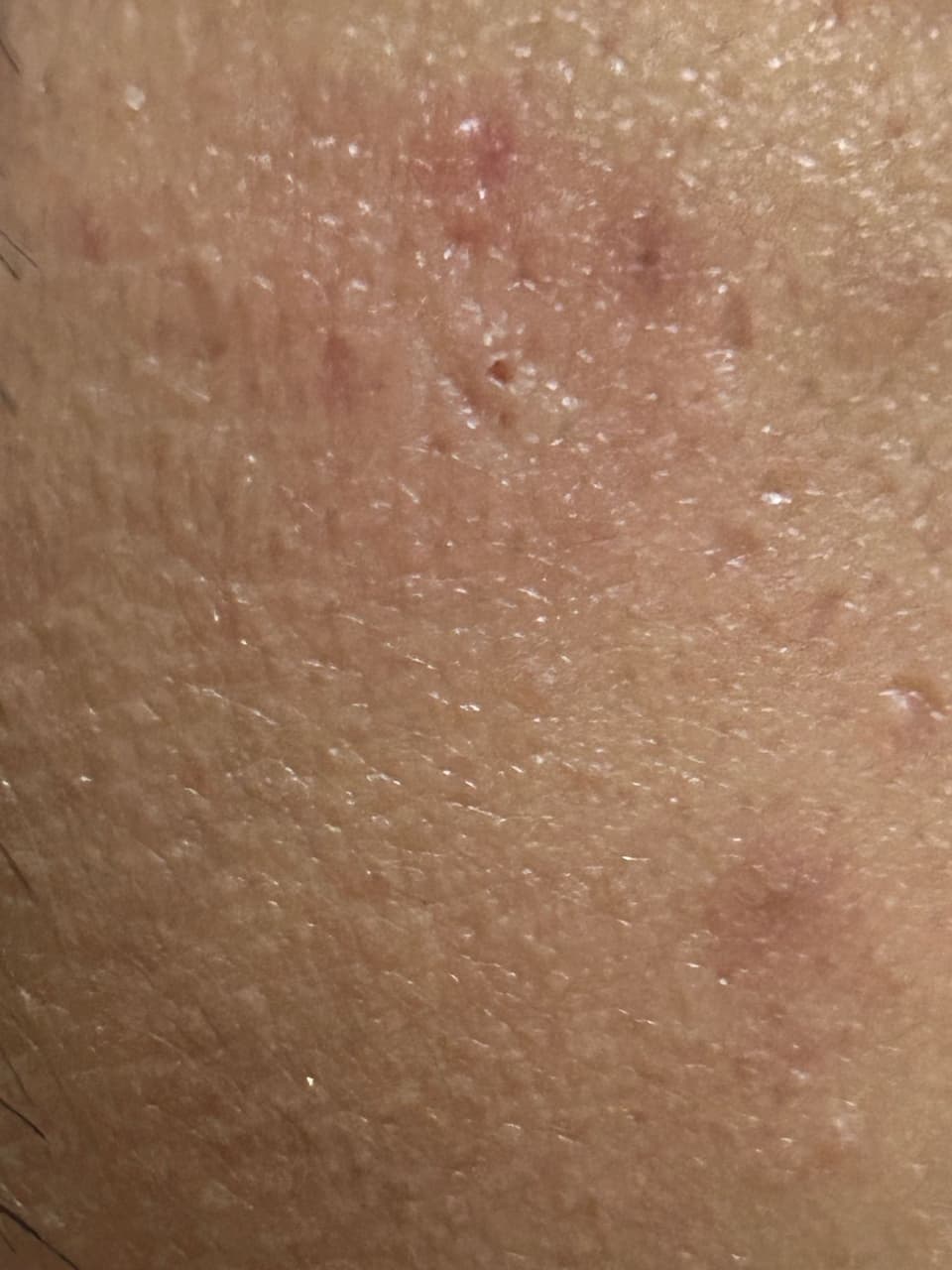 養超肥 EP2 - 粉刺愛好者板 | Dcard