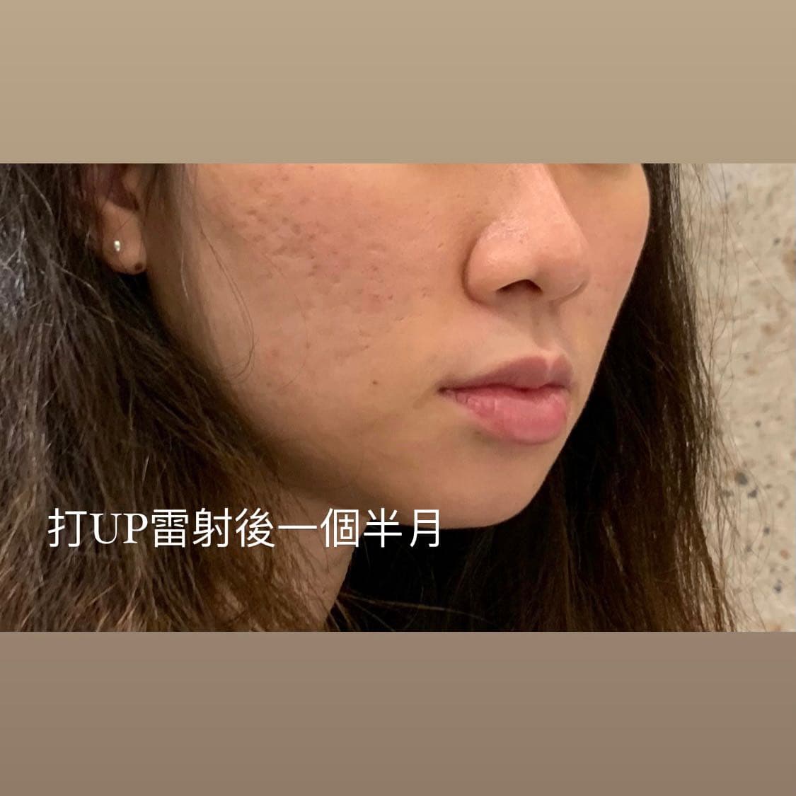 #討論 打完UP雷射皮膚變得更差了 - 醫美板 | Dcard