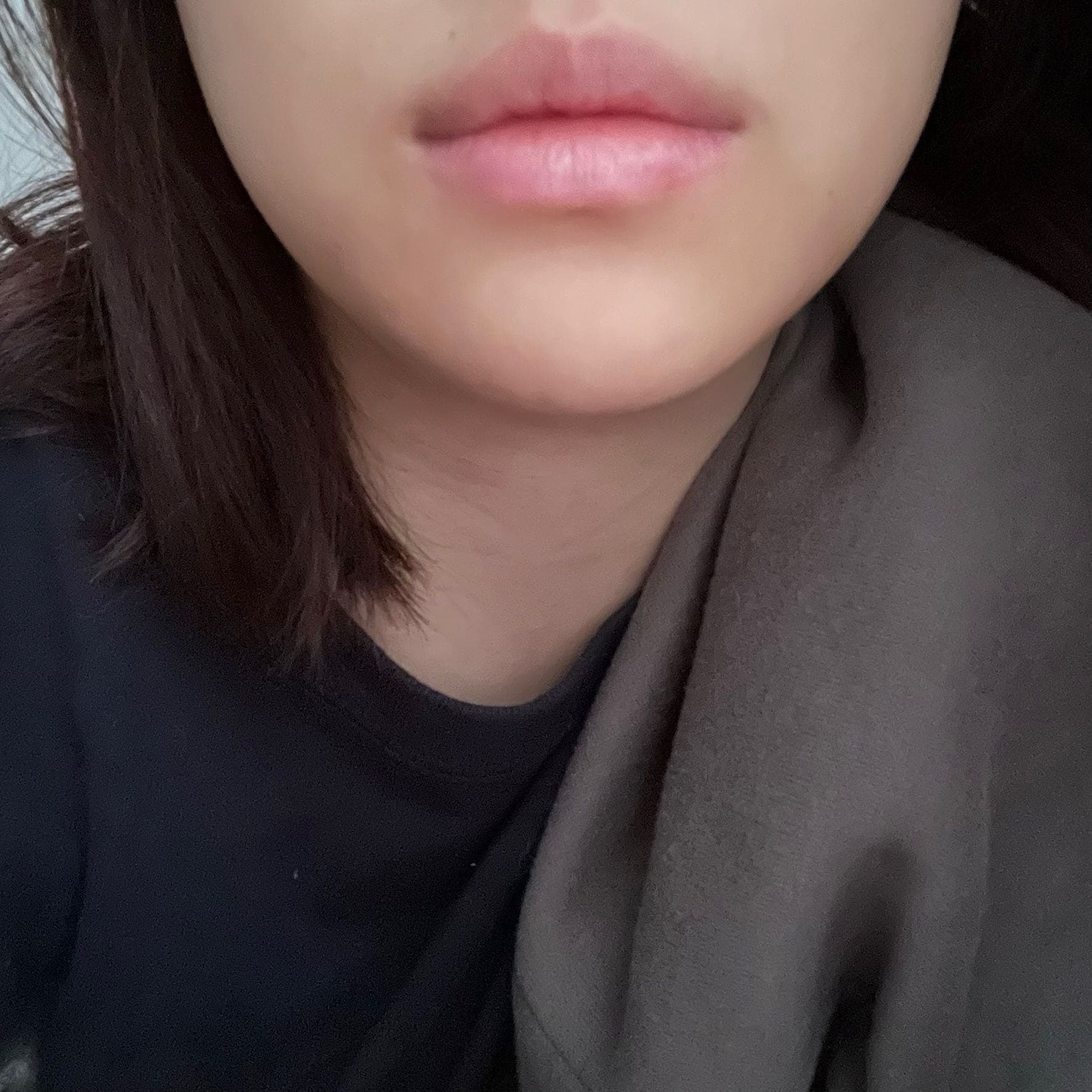 #分享 終於擁有M唇🥹👄 - 醫美板 | Dcard