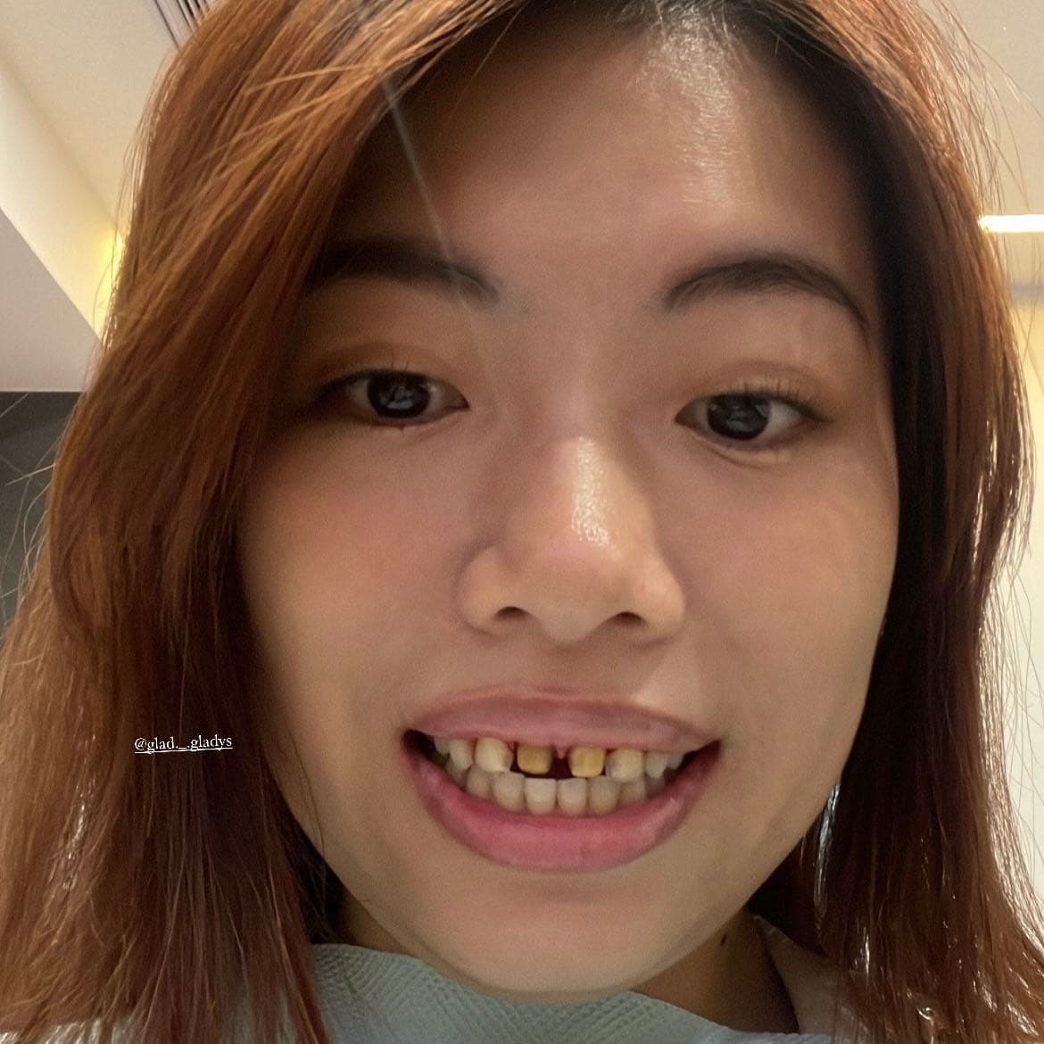 我終於去做瓷牙貼片了！實際去諮詢、療程&後續的感受分享🦷 - 美妝板 | Dcard